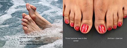 hammertoe