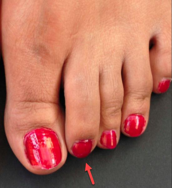 How can claw toes be treated surgically?
